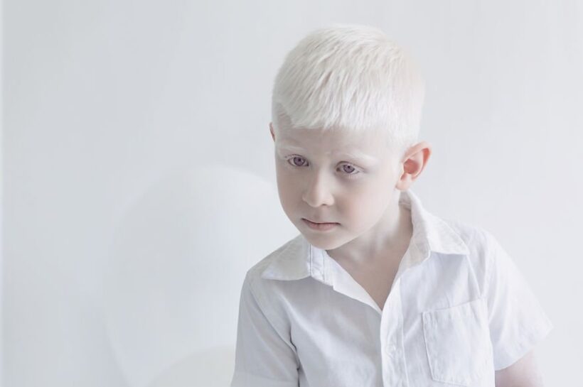 Can Albino People Dye Their Hair? Debunking Myths and Sharing Hair Care ...