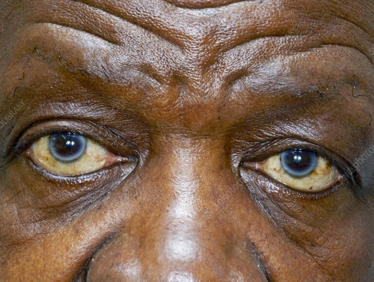Do Your Eyes Turn Grey When You Become Blind? Debunking Myths - The ...