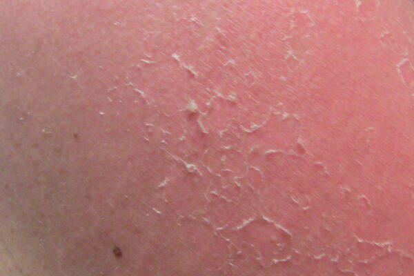 When I Rub My Skin It Rolls Off? Understanding Skin Behavior and ...